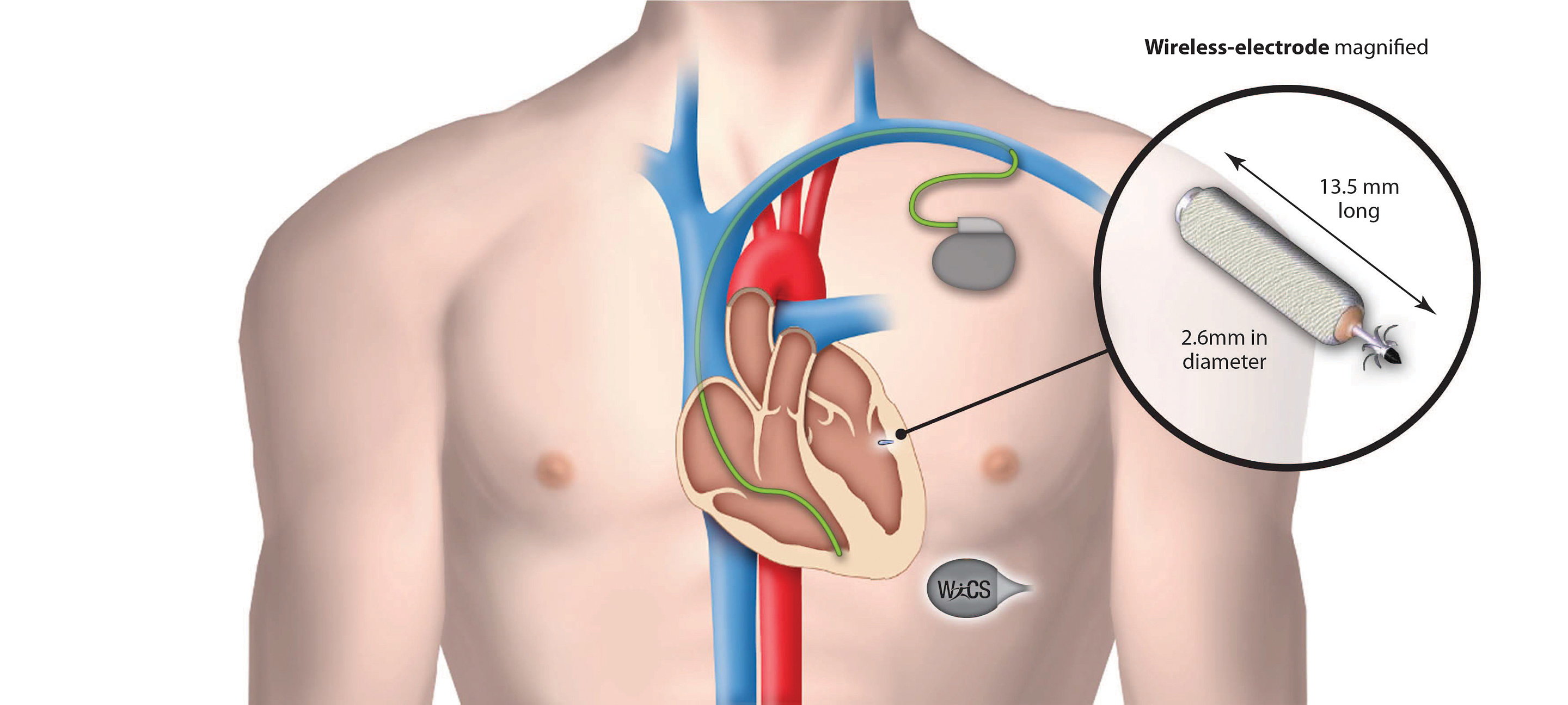 Revolutionary Leadless Pacemaker From Cambridge Consultants